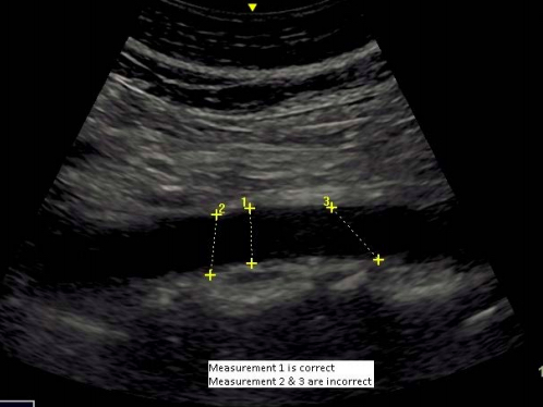 Abdominal aortic aneurysms: Dr Vimal Someshwar’s talk – Cafe Roentgen