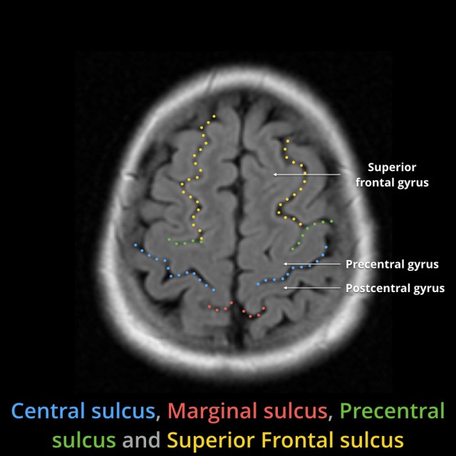 Basics of neuroanatomy and neurofunction: Dr Meher Ursekar’s talk ...