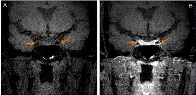 Vascular beading and stroke: Dr Sumeet Dua’s talk – Cafe Roentgen