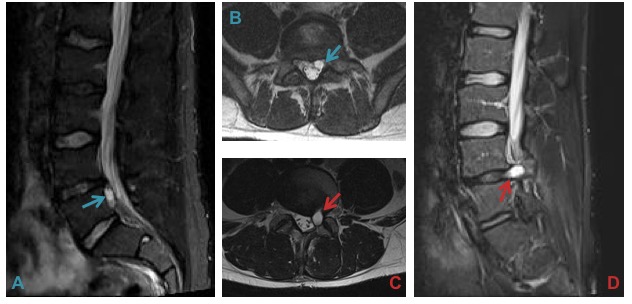 Pathologies of the Spinal Epidural Space: Dr Sumeet Dua’s Talk – Cafe ...