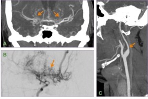 Vascular beading and stroke: Dr Sumeet Dua’s talk – Cafe Roentgen