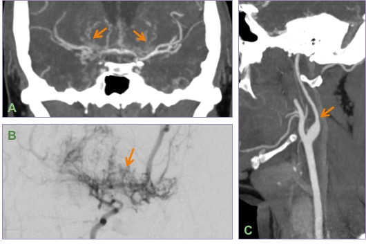 Vascular beading and stroke: Dr Sumeet Dua’s talk – Cafe Roentgen