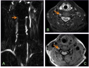 Vascular beading and stroke: Dr Sumeet Dua’s talk – Cafe Roentgen