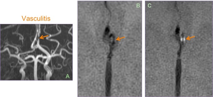 Vascular beading and stroke: Dr Sumeet Dua’s talk – Cafe Roentgen