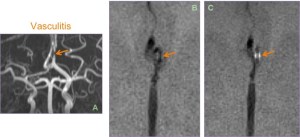 Vascular beading and stroke: Dr Sumeet Dua’s talk – Cafe Roentgen