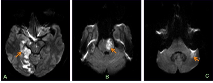 Vascular beading and stroke: Dr Sumeet Dua’s talk – Cafe Roentgen