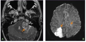 Vascular beading and stroke: Dr Sumeet Dua’s talk – Cafe Roentgen