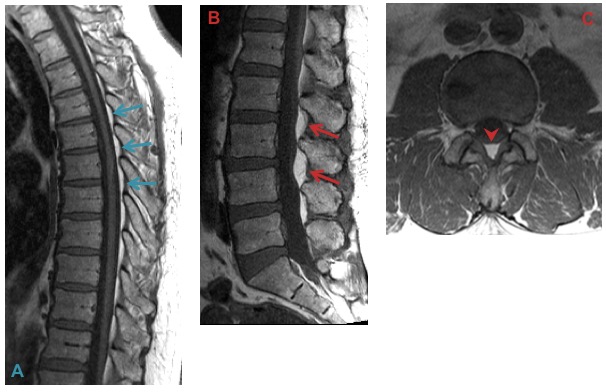 Pathologies of the Spinal Epidural Space: Dr Sumeet Dua’s Talk – Cafe ...