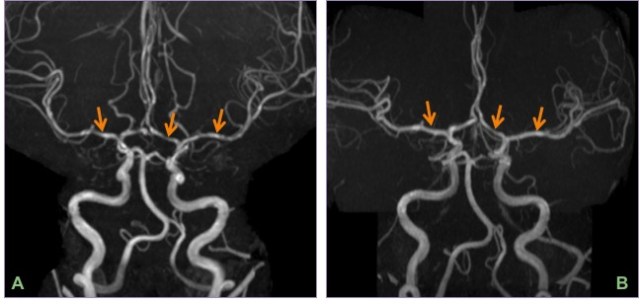 Vascular beading and stroke: Dr Sumeet Dua’s talk – Cafe Roentgen
