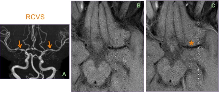 Vascular beading and stroke: Dr Sumeet Dua’s talk – Cafe Roentgen