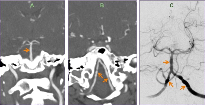 Vascular beading and stroke: Dr Sumeet Dua’s talk – Cafe Roentgen