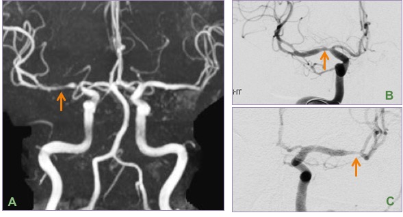 Vascular beading and stroke: Dr Sumeet Dua’s talk – Cafe Roentgen