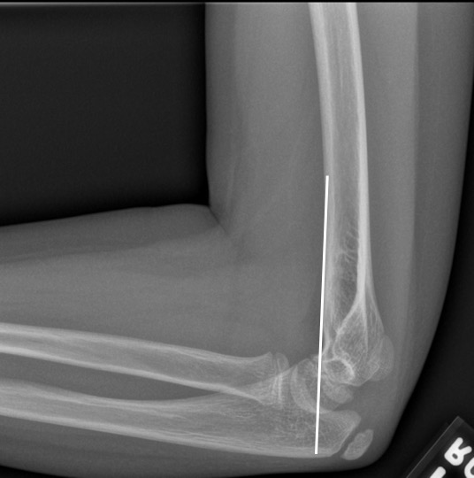 Pediatric elbow imaging: Dr Sachin Kumbhar’s talk – Cafe Roentgen