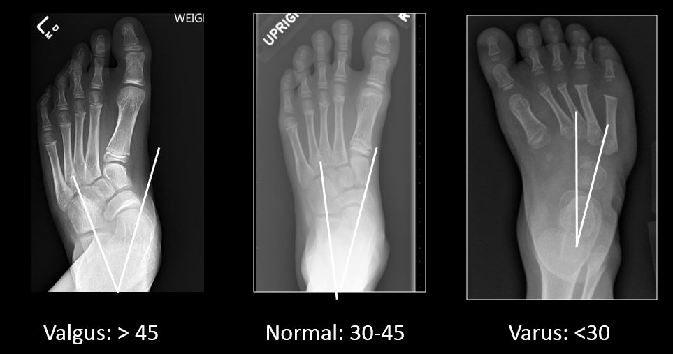 Pediatric foot alignment: Dr Sachin Kumbhar’s talk – Cafe Roentgen