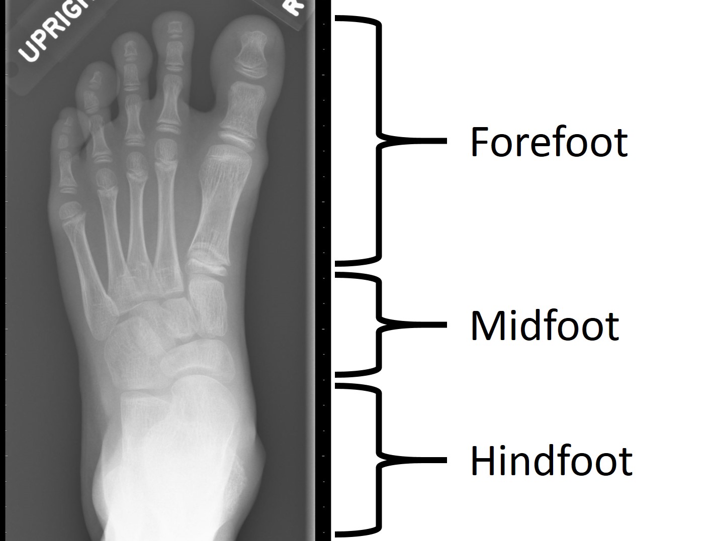 Pediatric foot alignment: Dr Sachin Kumbhar’s talk – Cafe Roentgen