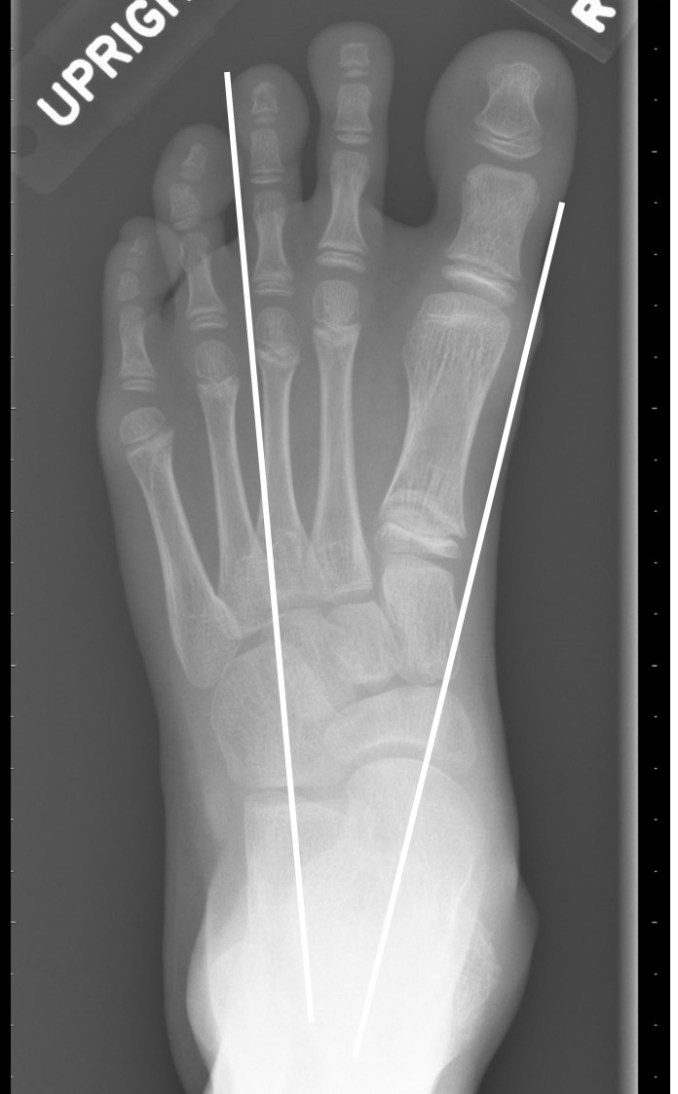 Pediatric foot alignment: Dr Sachin Kumbhar’s talk – Cafe Roentgen