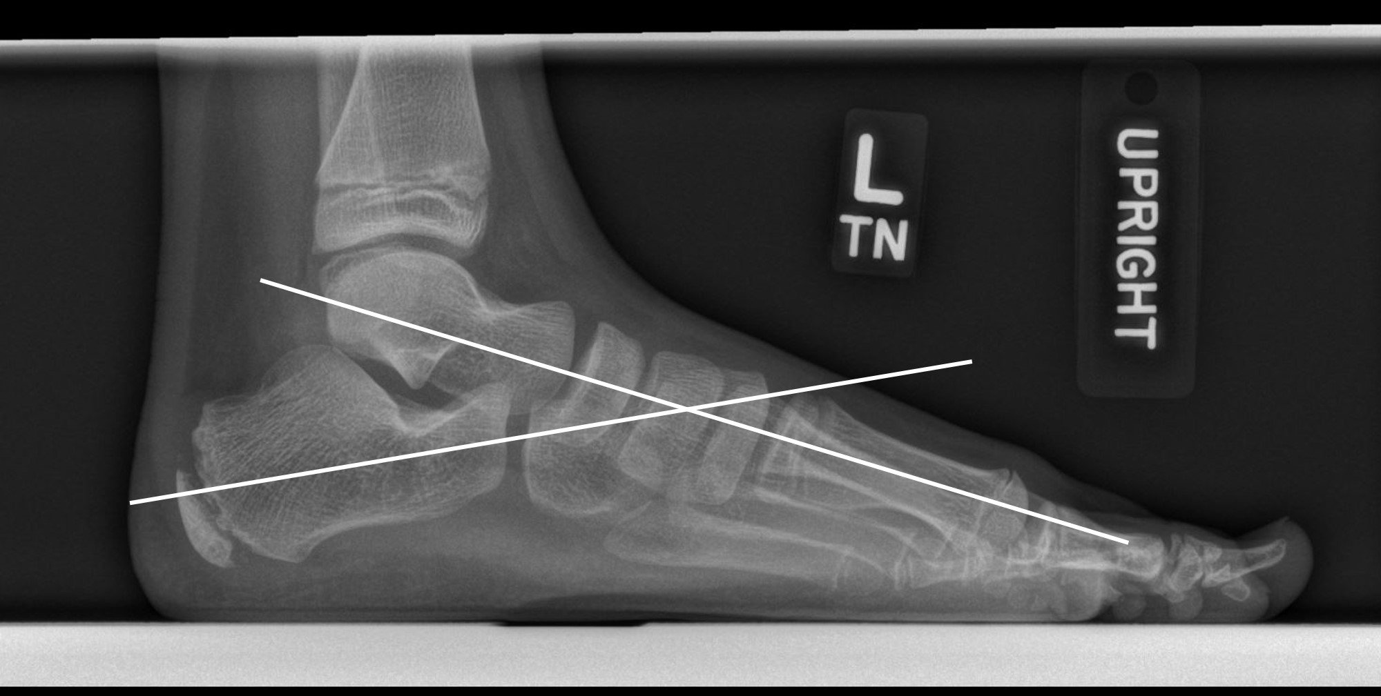 Pediatric foot alignment: Dr Sachin Kumbhar’s talk – Cafe Roentgen