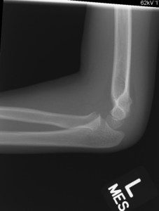 Pediatric elbow imaging: Dr Sachin Kumbhar’s talk – Cafe Roentgen