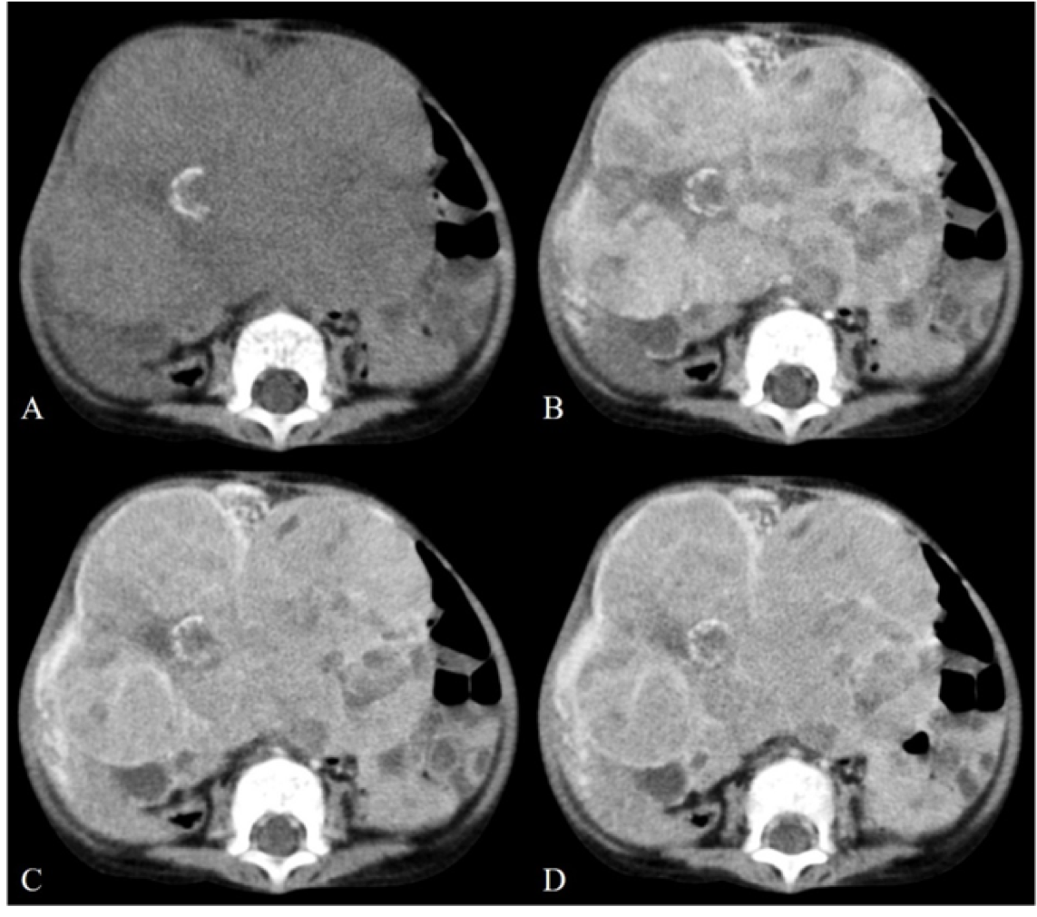 Pediatric liver imaging: Dr Govind Chavhan’s talk – Cafe Roentgen