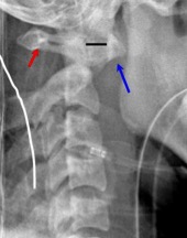 Essentials of Spinal X-rays: Dr Malini Lawande’s talk – Cafe Roentgen
