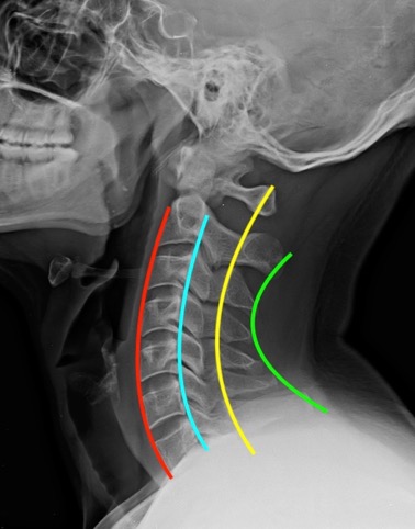 Essentials of Spinal X-rays: Dr Malini Lawande’s talk – Cafe Roentgen