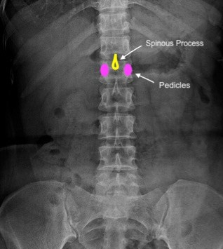 Essentials of Spinal X-rays: Dr Malini Lawande’s talk – Cafe Roentgen
