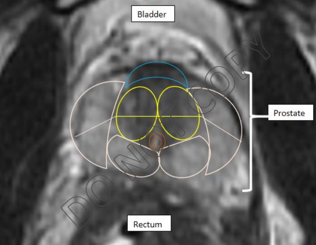 Approach to prostate MRI: Dr Palak Popat’s talk – Cafe Roentgen