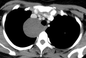 The Cervicothoracic sign: Dr Ravi Ramakantan’s film reading session ...
