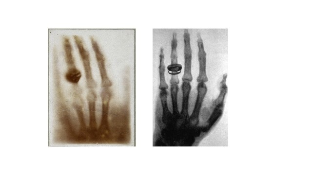 A Tale of Two Hands: The Story behind the Two Famous Radiographs ...